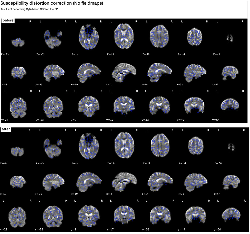 SyN-based SDC, fieldmap-less estimation - fmriprep - Neurostars