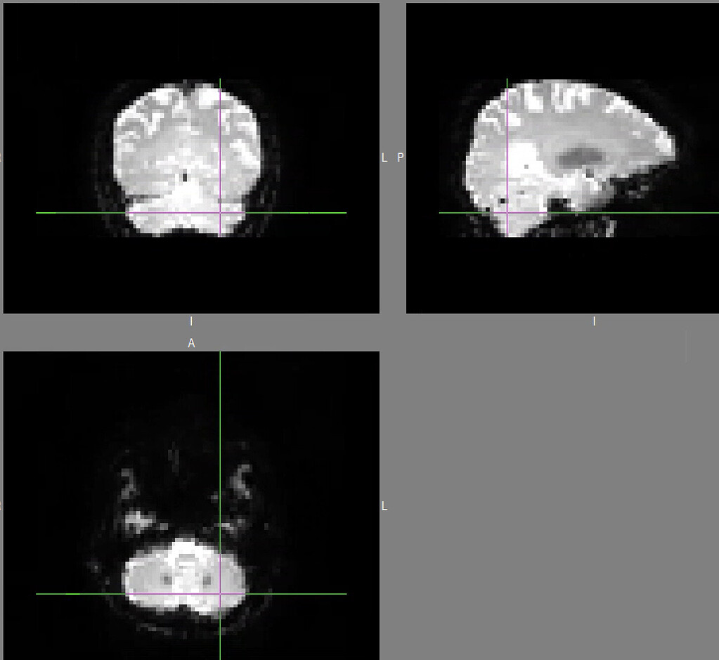fMRIPrep distortion correction issue hyperintensity in cerebellum ...