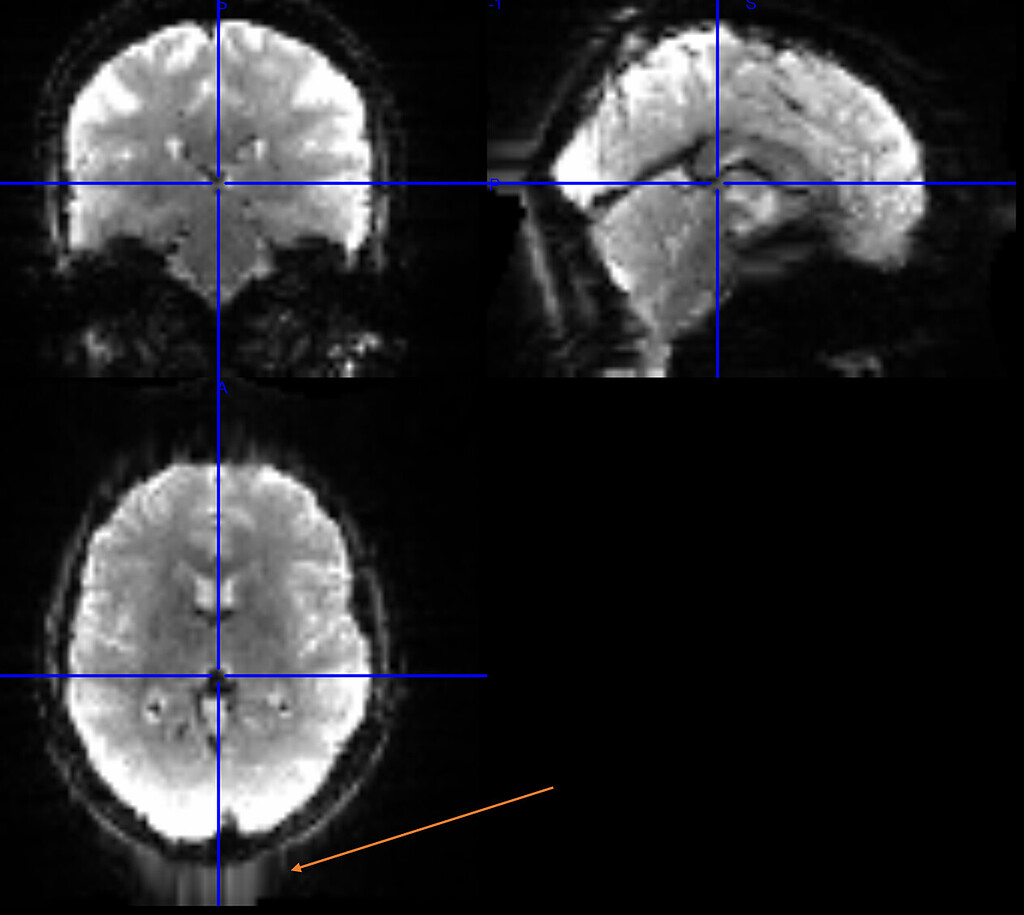 Multi - echo pepolar fielmaps in CONN toolbox - fmri - Neurostars