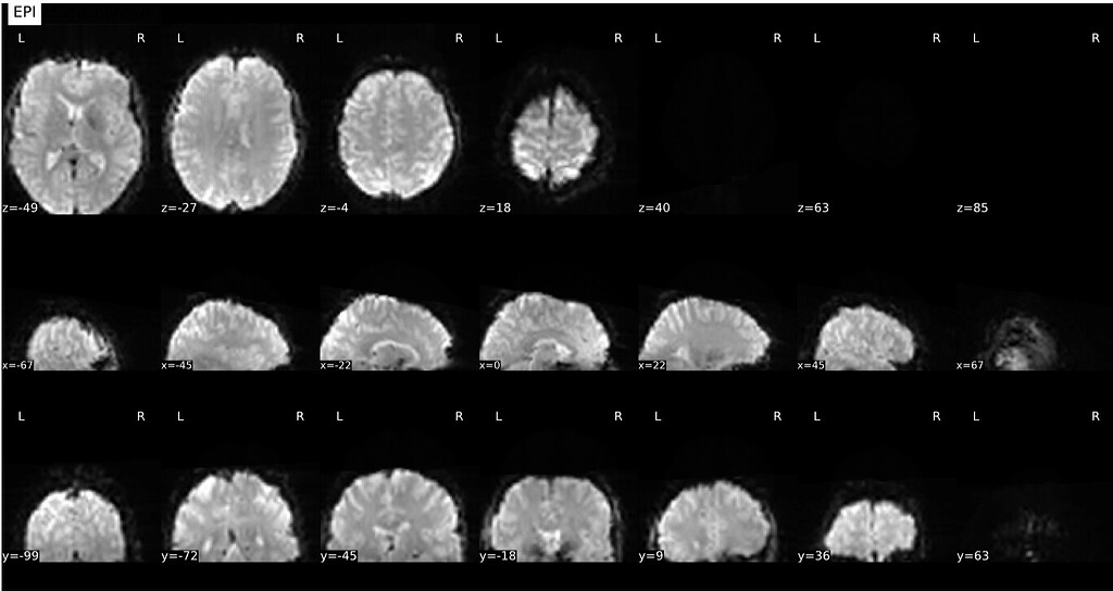 fMRIPost-AROMA - Consistent poor alignment of functional and template MRI data - Software ...