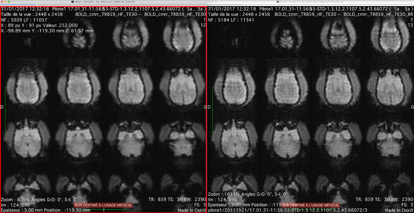 Gibbs artifact in EPI data - is it handled in fmriprep? - fmriprep ...