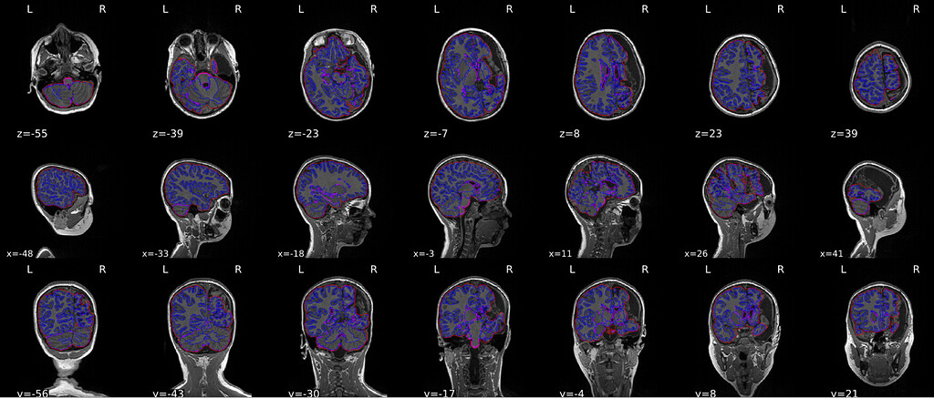 Hand painted hemispheric lesion mask seems not used by the pipeline ...