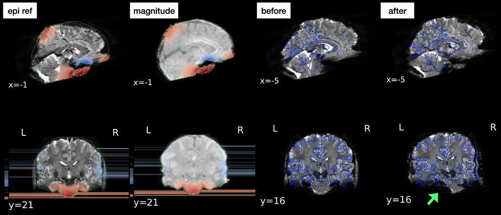 Distortion correction via phase difference image produces oddly ...