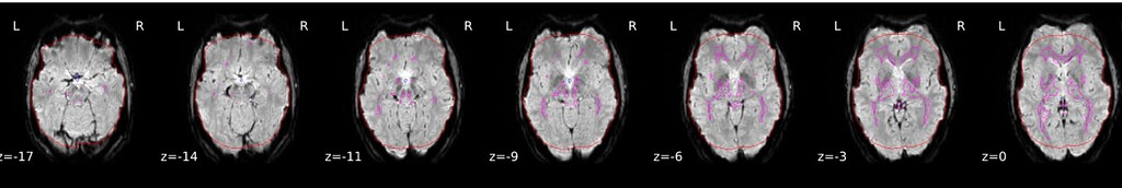 fMRIPREP: Functional brainmask estimation issues - Software Support ...
