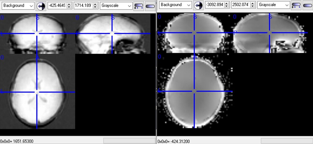 Types of fieldmaps from a Philips scanner - Software Support - Neurostars