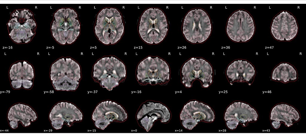 "Shrunken brains" seen with registration of EPI image to MNI space ...