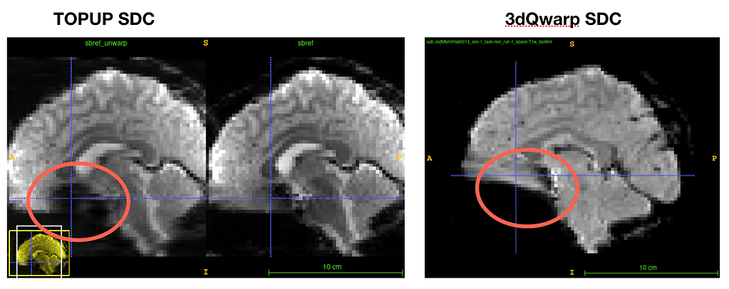 FMRIPREP distortion correction issues with higher resolution MB-EPI - Neurostars