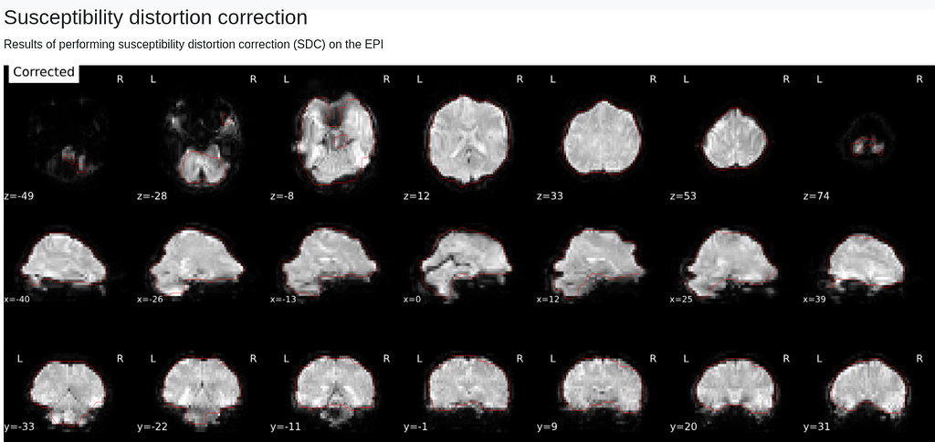 More distorted images are produced through SyN distortion correction ...