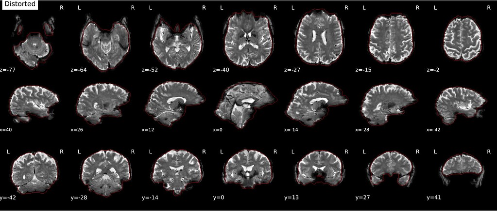 Improving susceptibility distortion correction with 7T data - fmri ...