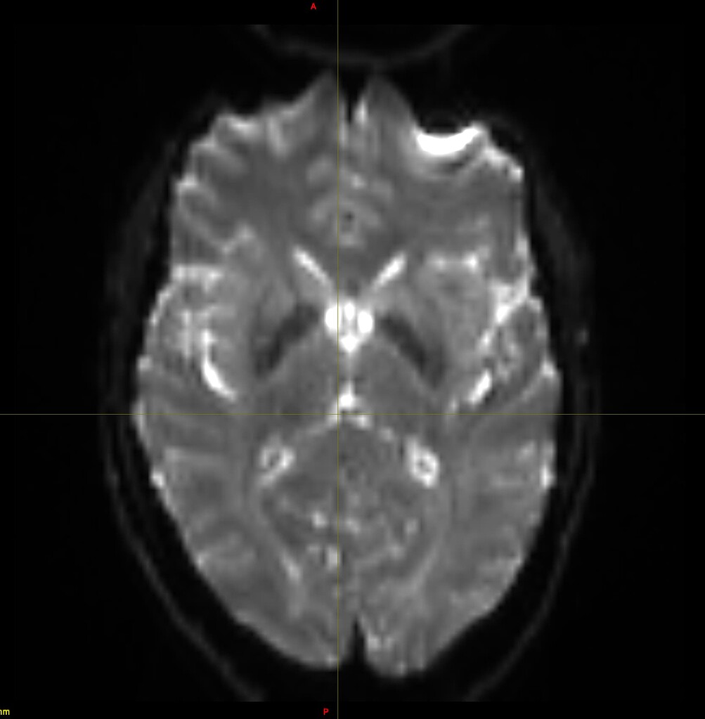 Qsiprep Preprocessing Issue - qsiprep - Neurostars Qsiprep Preprocessing Issue - qsiprep - Neurostars
