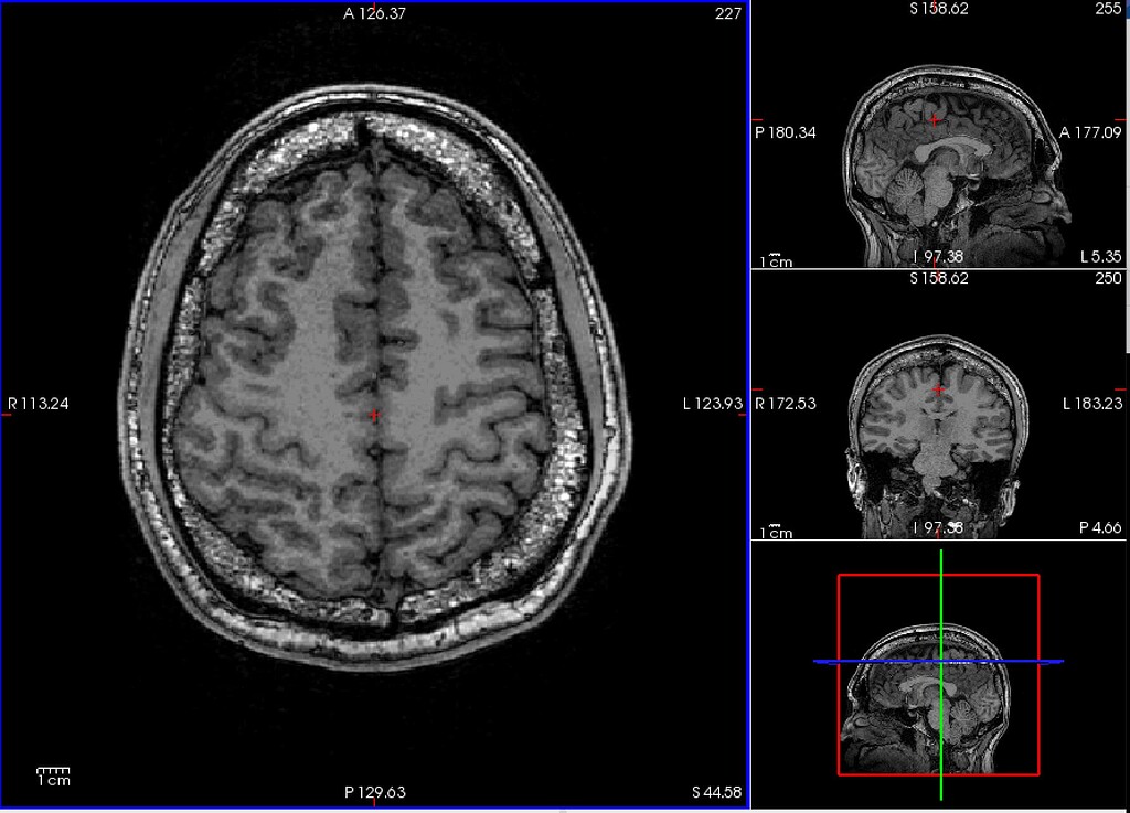 Recon-all stuck for one subject with thick diploe (spongy bone) during ...