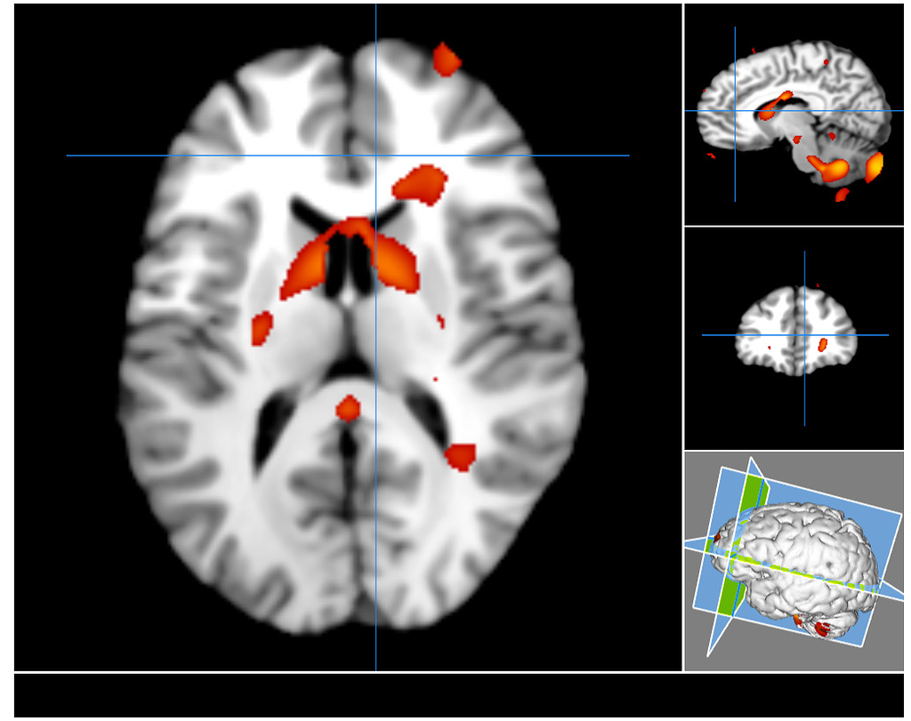 How To Perform Spm Massive Univariate Analysis Using Python Nilearn Neurostars 9291