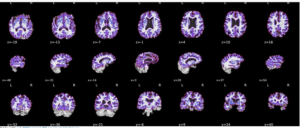 Issue w/ generating anatomical brain mask from pre-skull stripped T1w ...