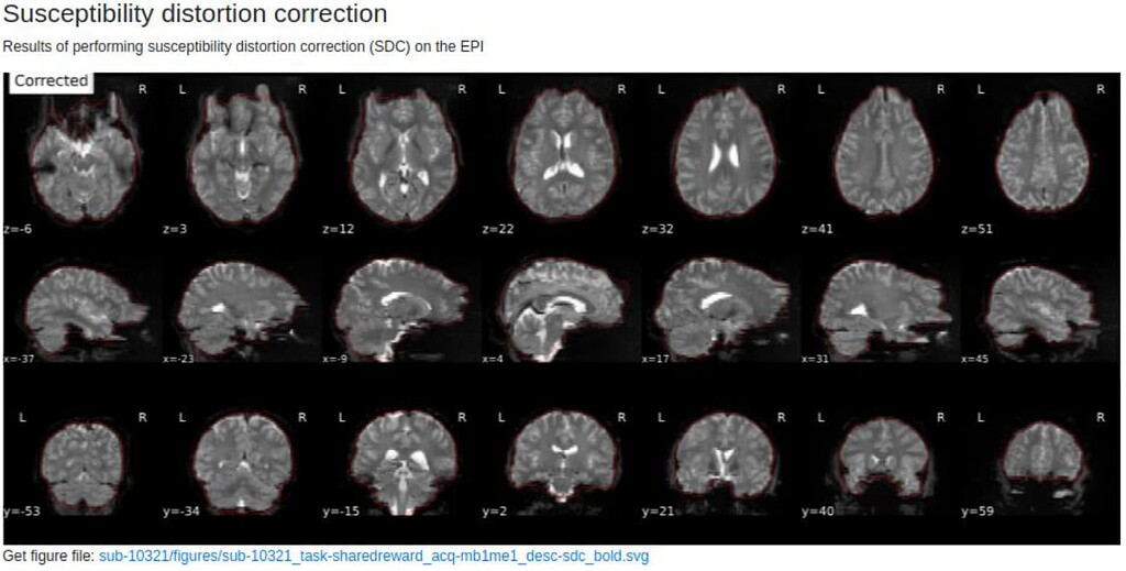 Increased Distortions Following Distortion Correction In Fmriprep Fmriprep Neurostars 