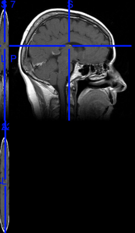 Combine multiple MRI partial acquisitions into a one file - mri ...