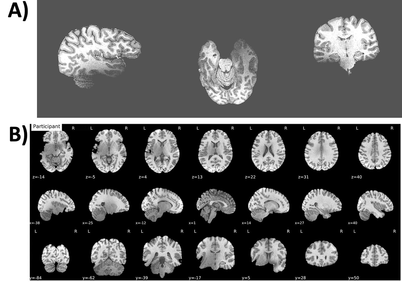 Spatial normalization issues using 7t MRI Scanner - fmri - Neurostars