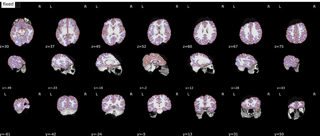 Brain images cropped during brain extraction and segmentation with ...