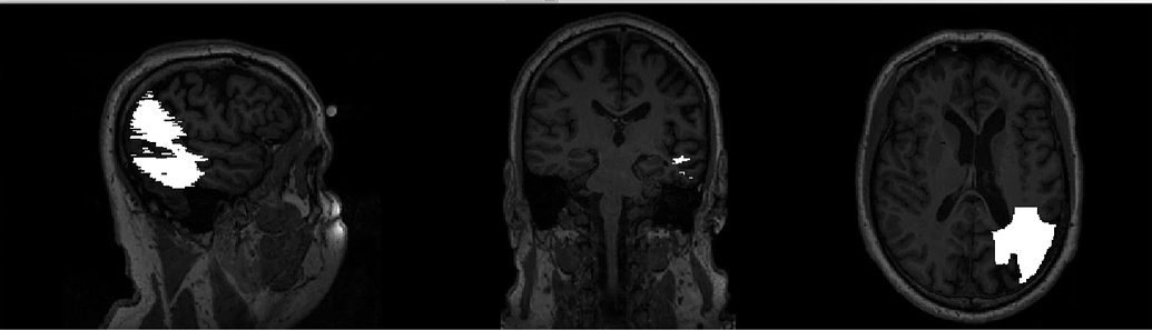 Fmriprep – Failed normalisation with lesion mask - fmriprep - Neurostars