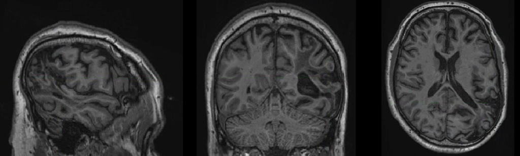 Fmriprep – Failed normalisation with lesion mask - fmriprep - Neurostars