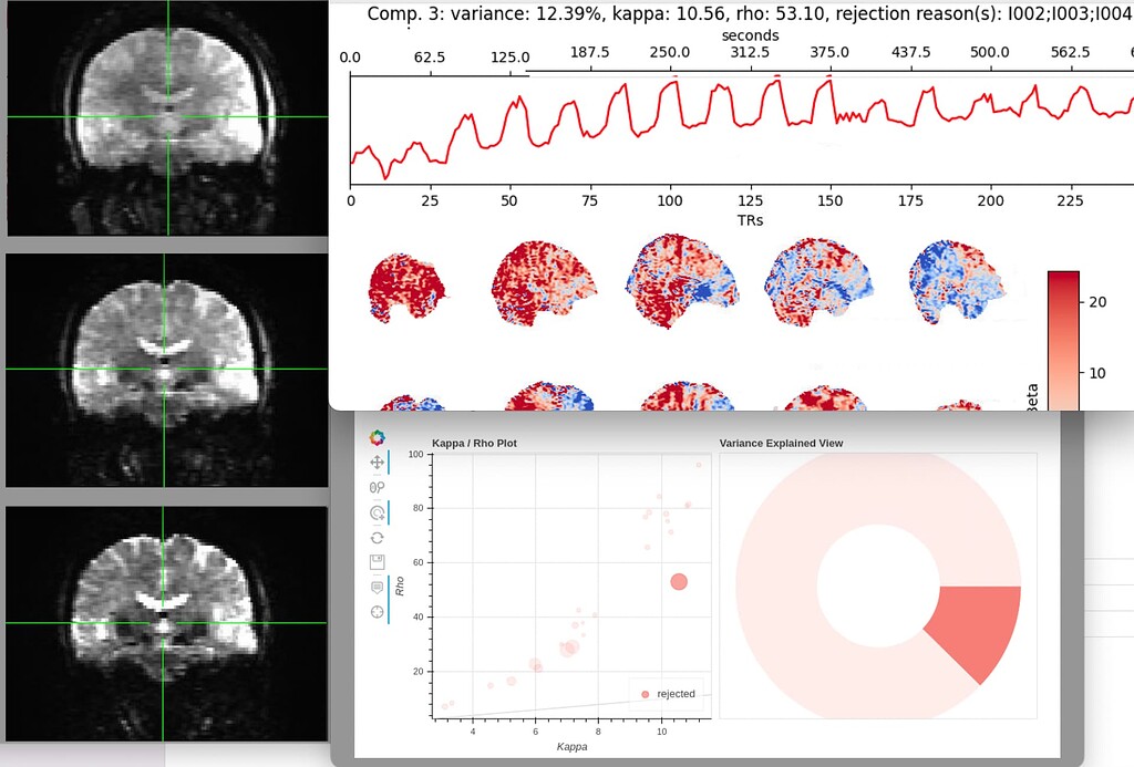 After multi-echo sequence upgrade, all components rejected by tedana ...