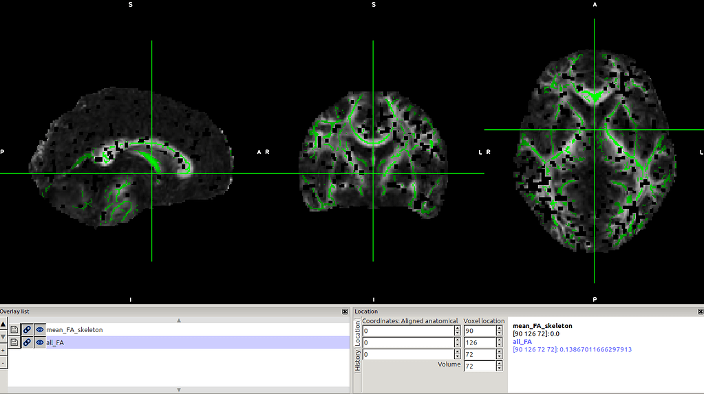 FSL TBSS question... Warping? - Neurostars