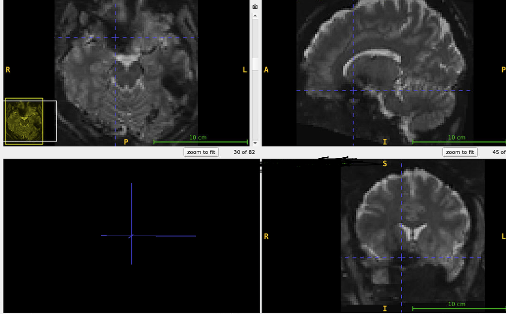 HCP dataset artifacts in cingulate girus and orbital frontal cortex ...