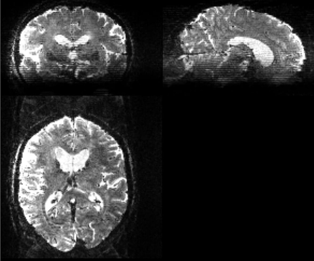 How to deal with "stripe" artifact in fMRI? - Neurostars