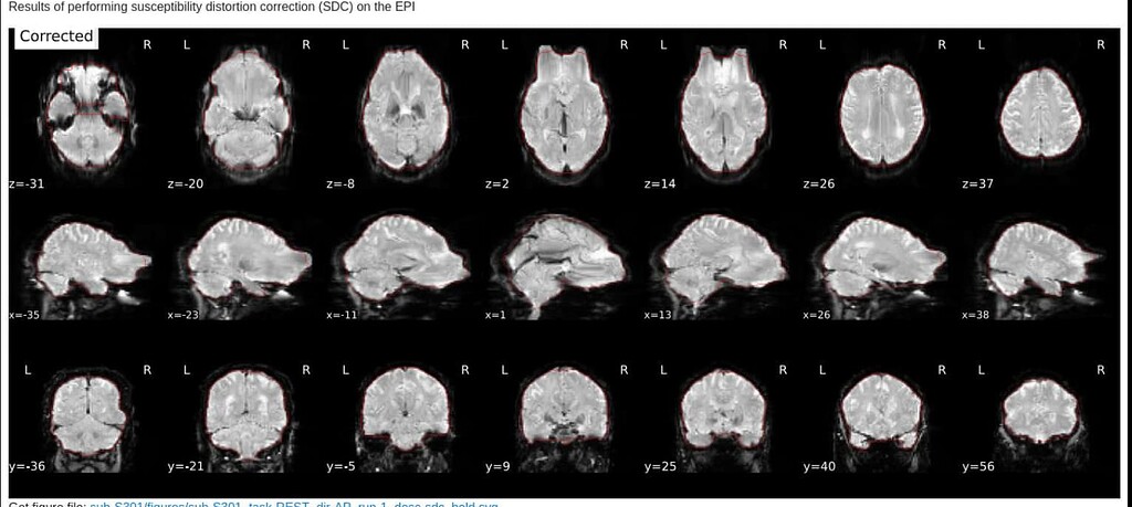 Elongated Brain: Errors in fMRIprep Susceptibility Distortion ...