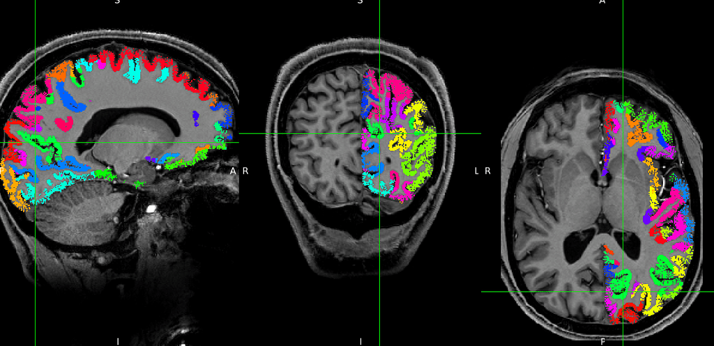 Optimising Freesurfer parcelation in volume space (mri_label2vol ...