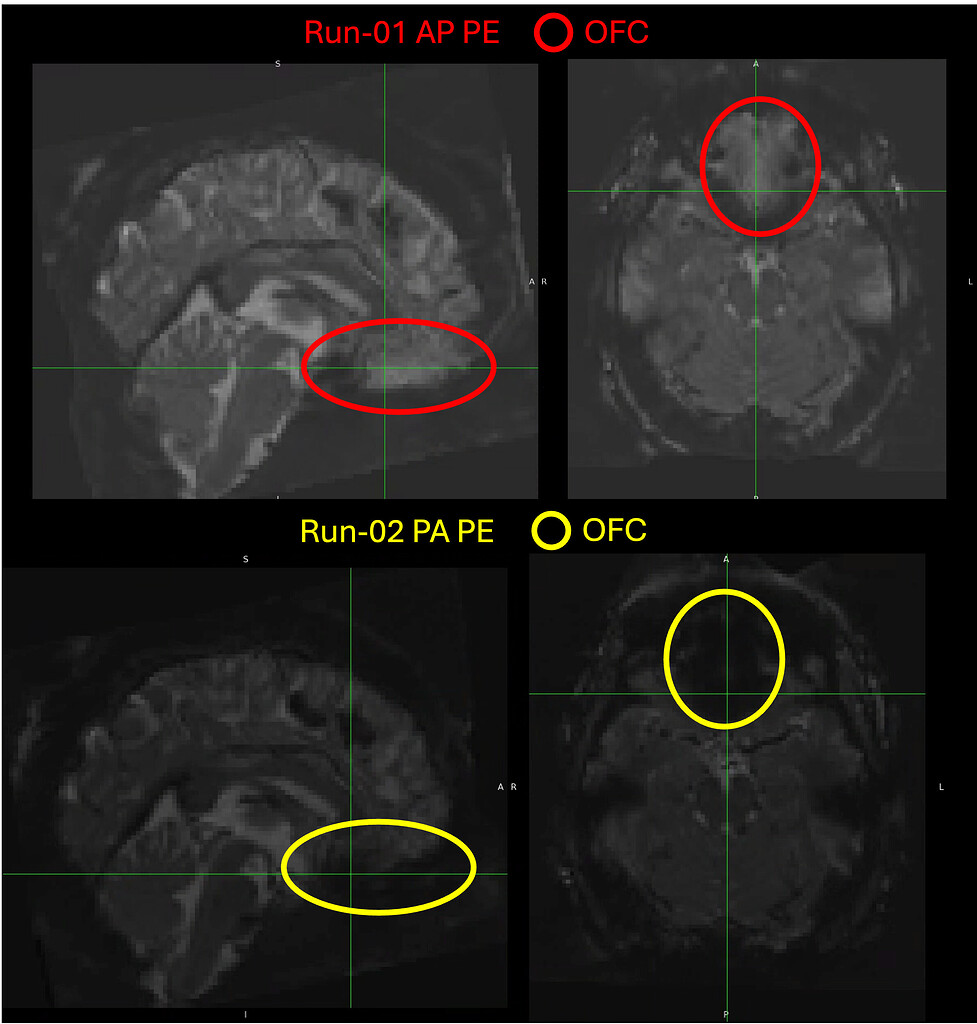First Level Analysis on Resting State Data with Multiple Phase Encoding ...