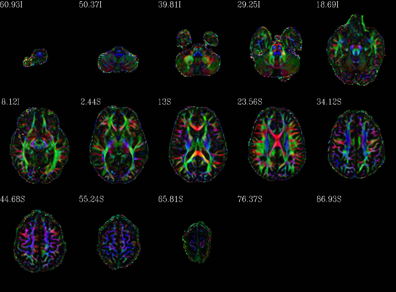 Significance Of Product Of Eigen Vector And FA Diffusion mri Neurostars Significance Of Product Of Eigen Vector And FA Diffusion mri Neurostars